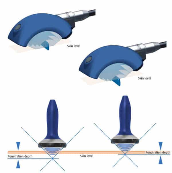 PiezoWave Therapy - The Best Solution For Fast Pain Relief